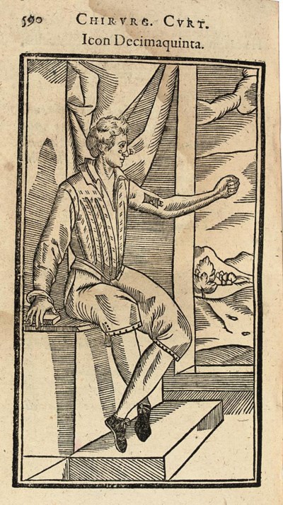 TAGLIACOZZI, Gaspare (1545-1599). Cheirurgia nova...de narium, aurium ...