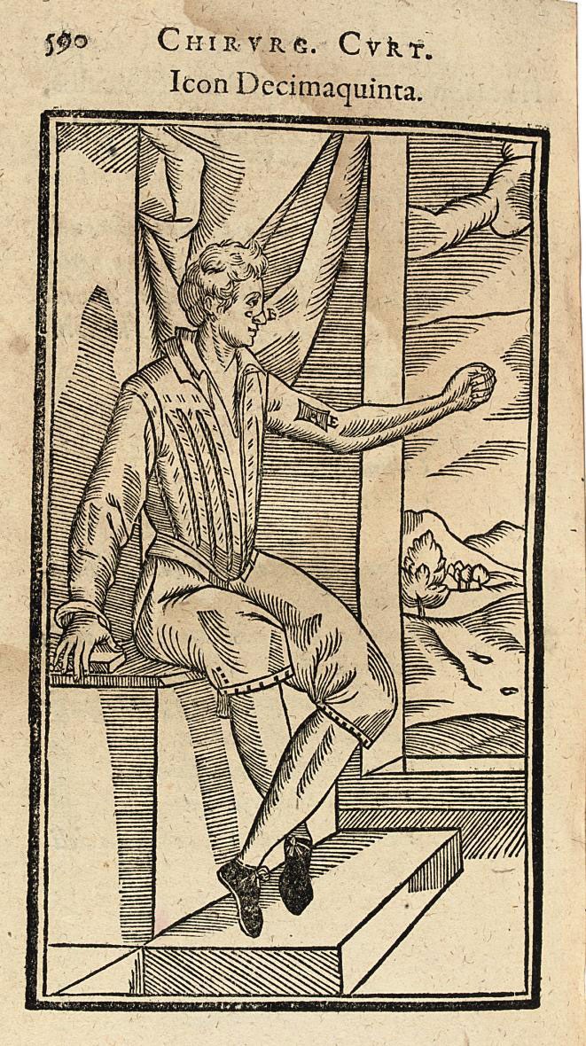 TAGLIACOZZI, Gaspare (1545-1599). Cheirurgia nova...de narium, aurium ...