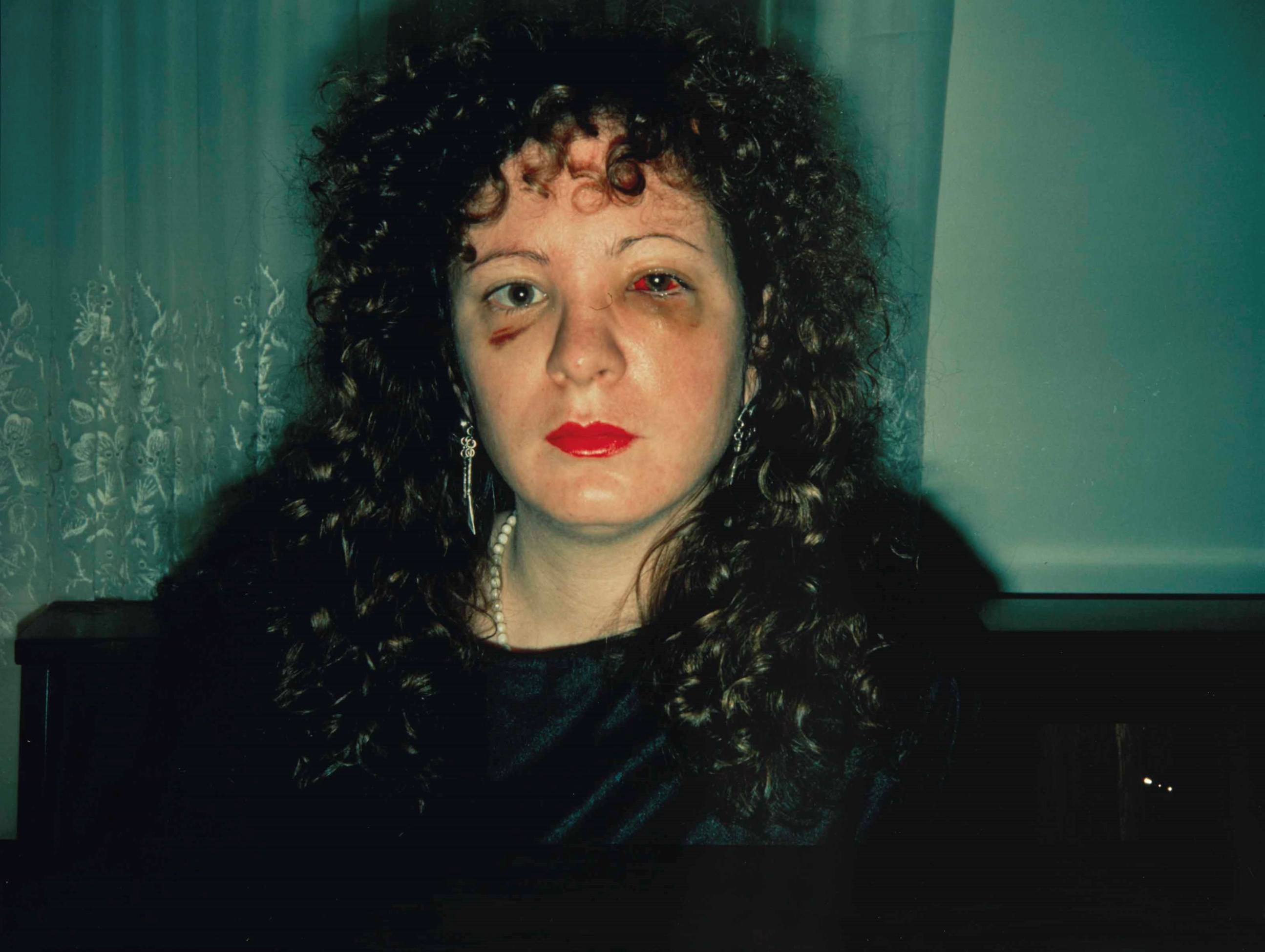 NAN GOLDIN (NÉE EN 1953), Nan One Month After Being Battered, 1984 ...