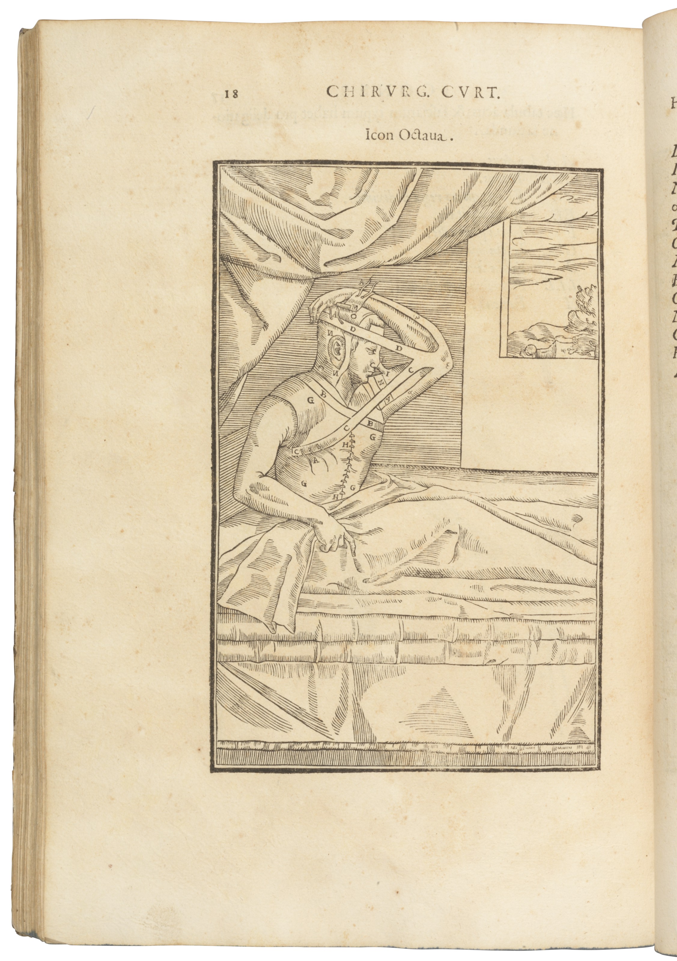 Gaspare Tagliacozzi (1545-1599)., De Curtorum Chirurgia per insitionem ...